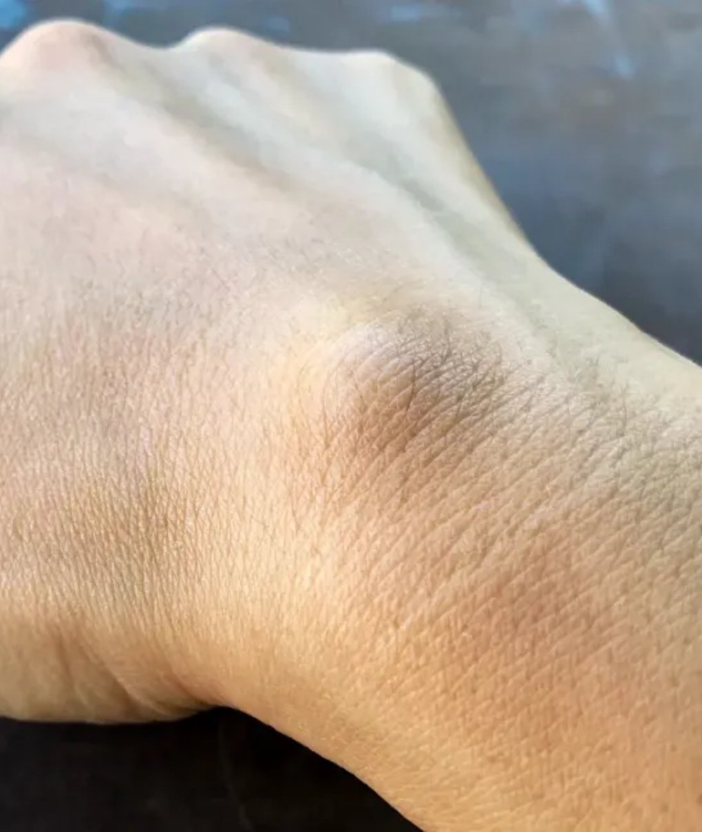 Multiple Cyst & Swelling Surgery in Ahmedabad | Kosmoplus